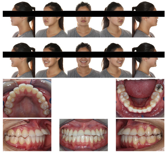 En-Mass Retraction of Maxillary Anterior Teeth with Severe Proclination ...