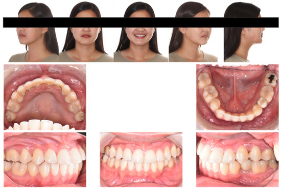 En-Mass Retraction of Maxillary Anterior Teeth with Severe Proclination ...