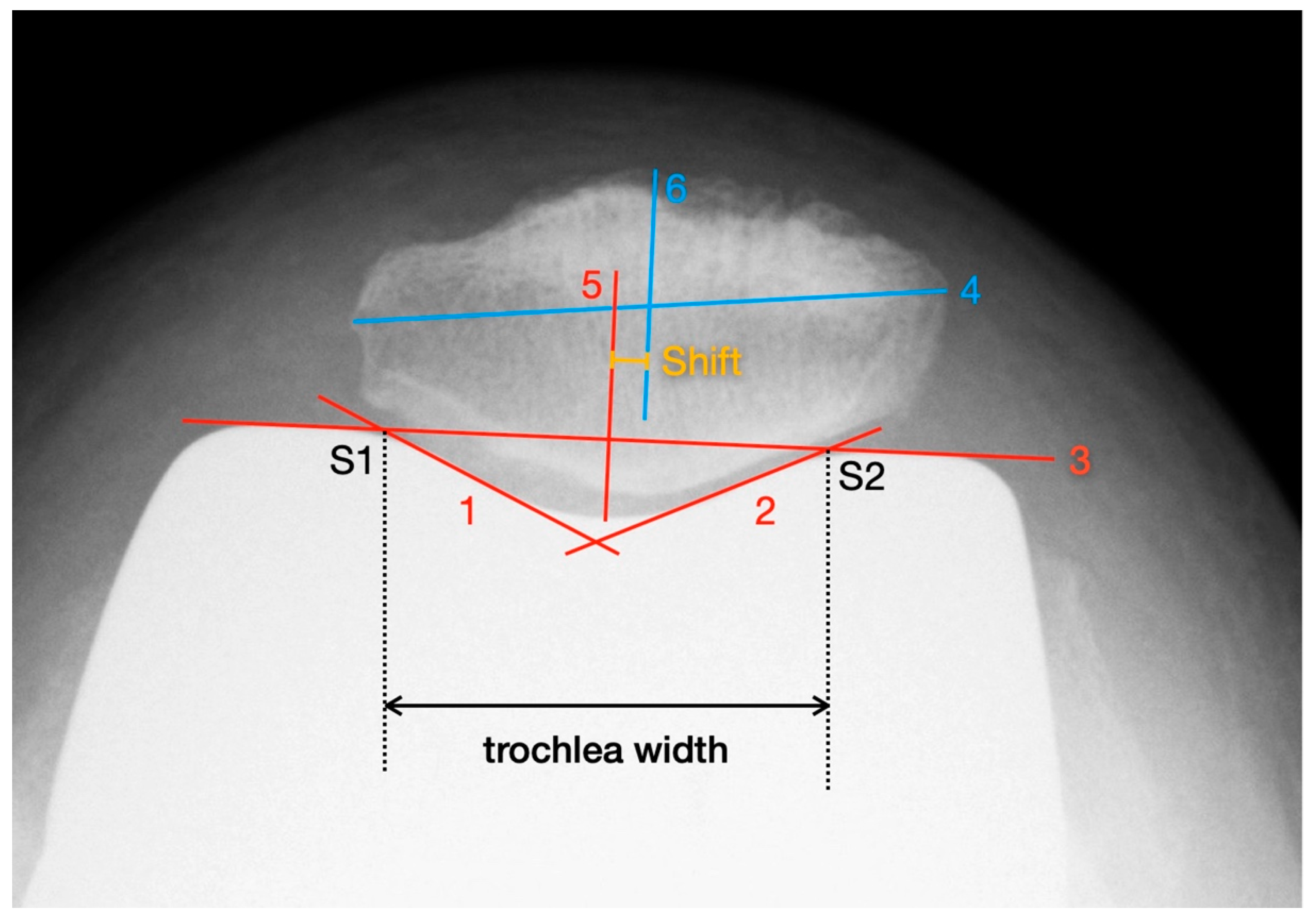 Patellar Tracking in Total Knee Arthroplasty—Influence on Clinical and ...