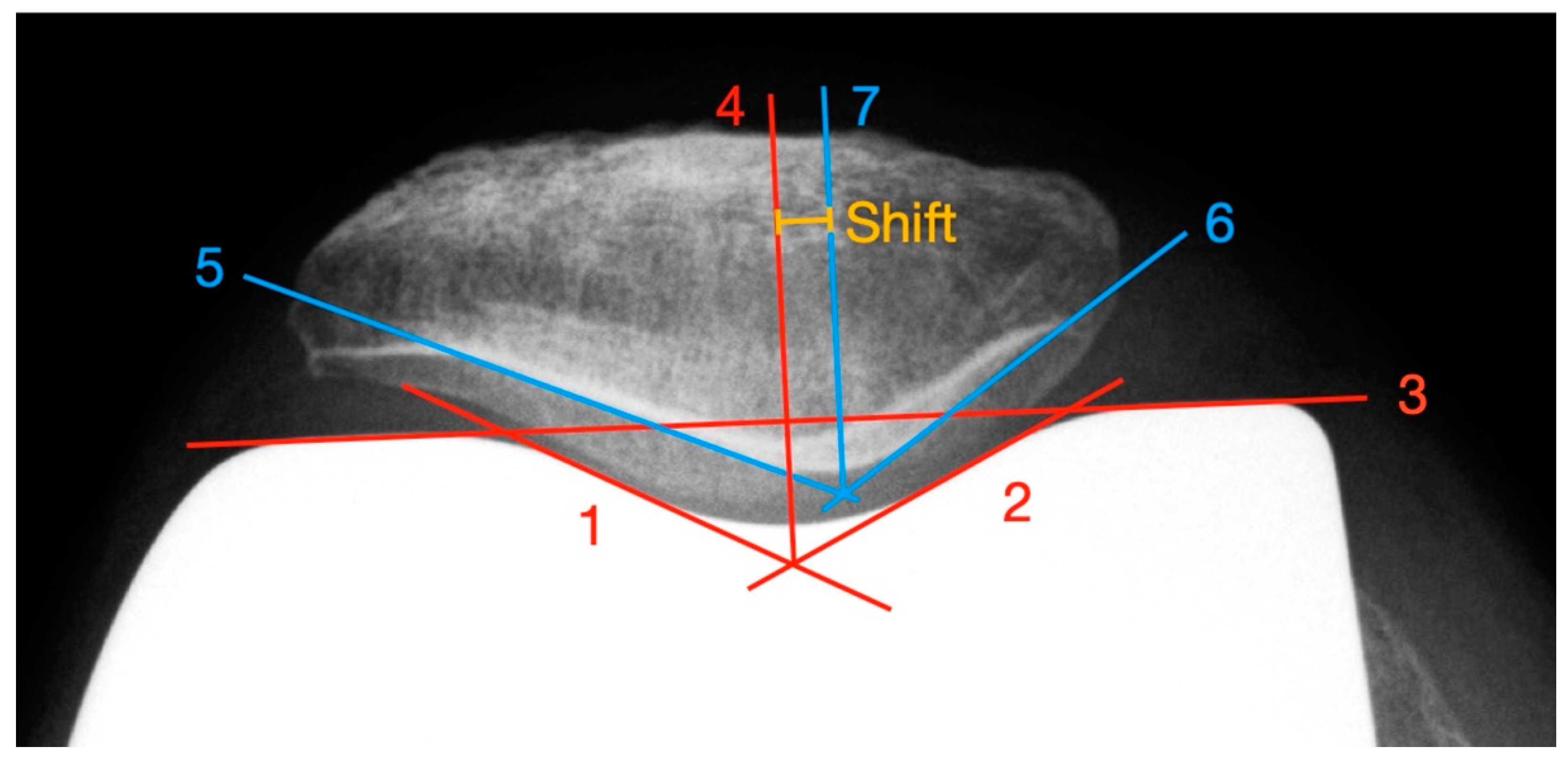 Patellar Tracking in Total Knee Arthroplasty—Influence on Clinical and ...