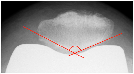 Patellar Tracking in Total Knee Arthroplasty—Influence on Clinical and ...