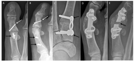 Postoperative Findings of Common Foot and Ankle Surgeries: An Imaging ...