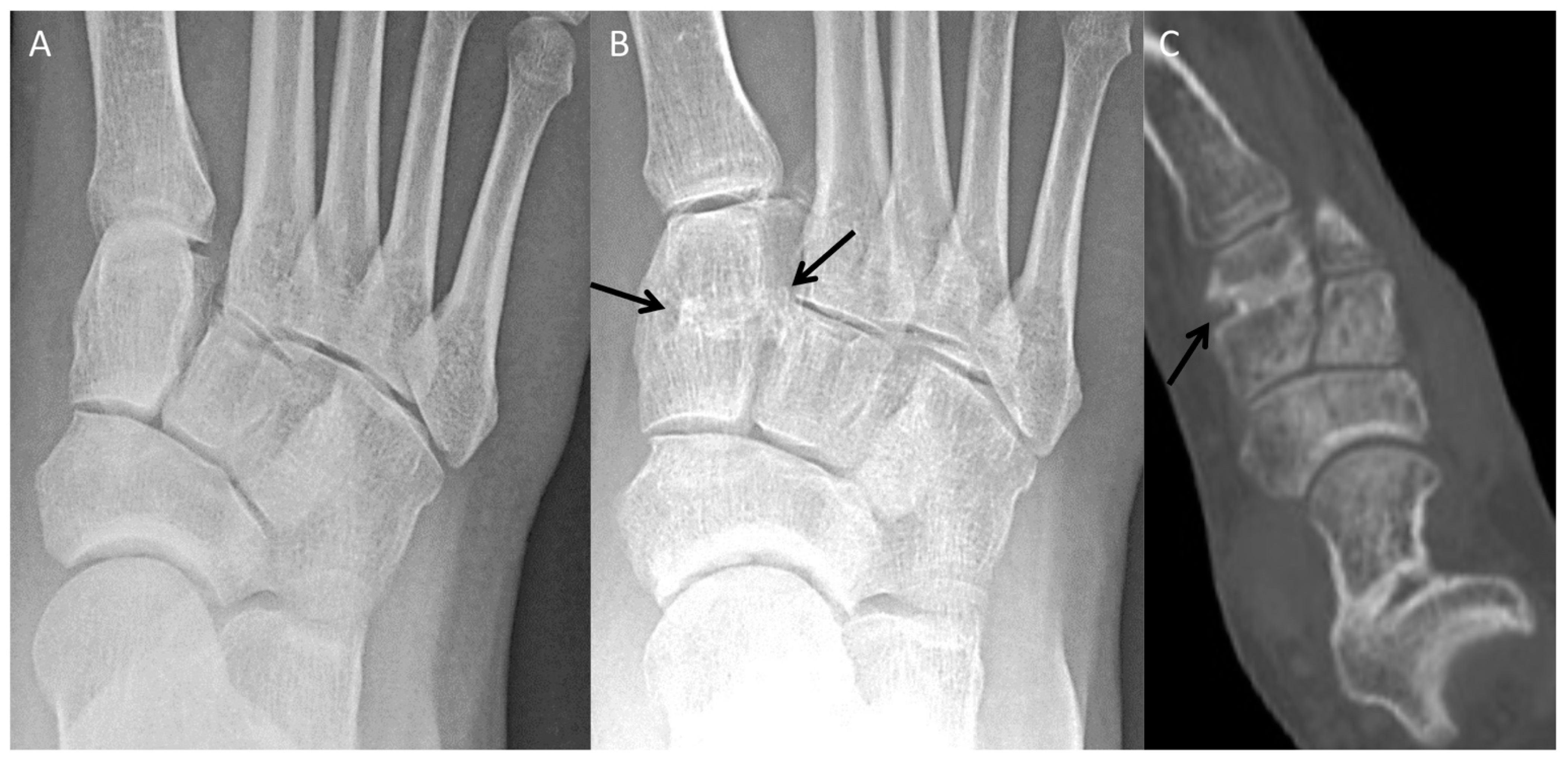 Postoperative Findings of Common Foot and Ankle Surgeries: An Imaging ...
