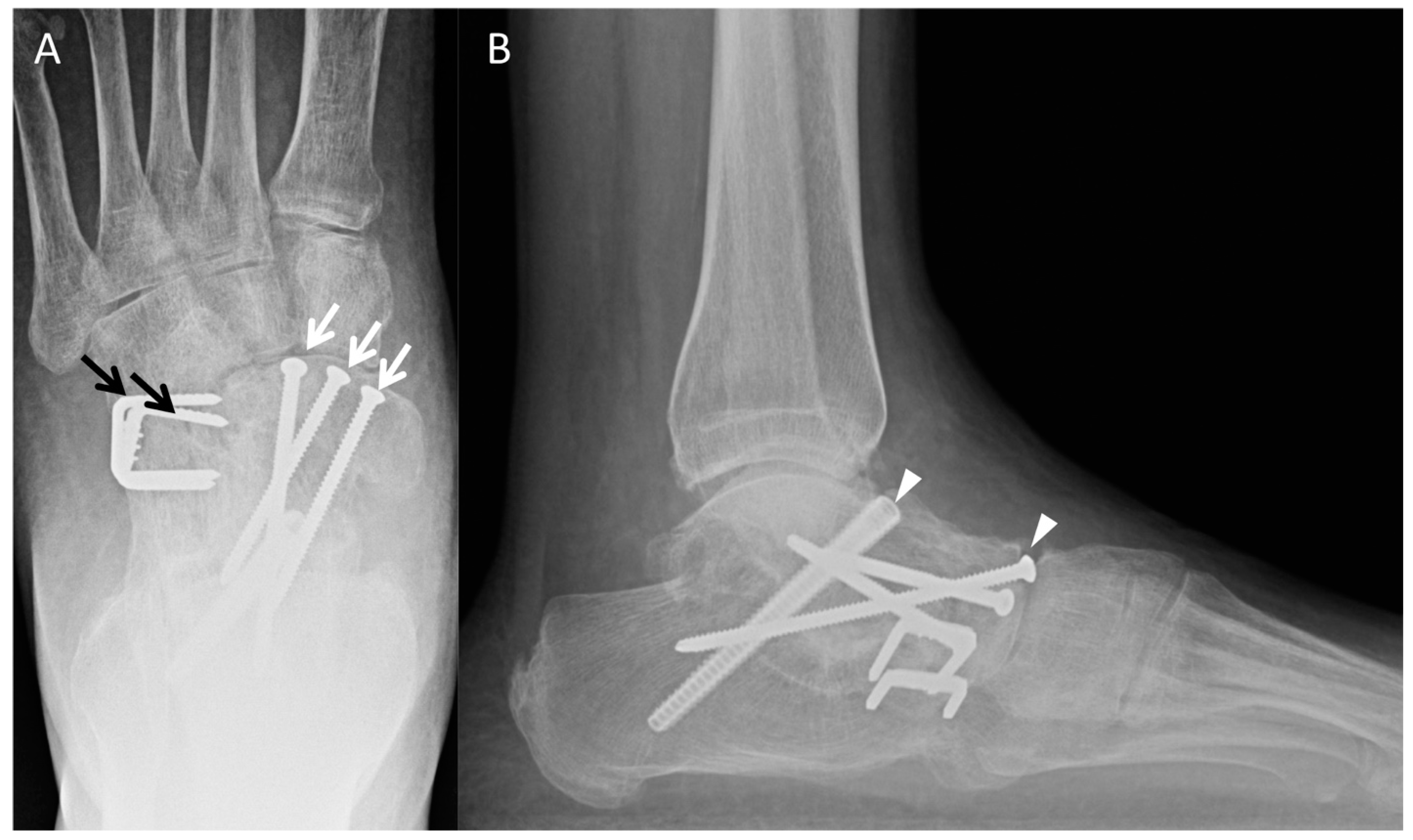Diagnostics | Free Full-Text | Postoperative Findings of Common Foot ...