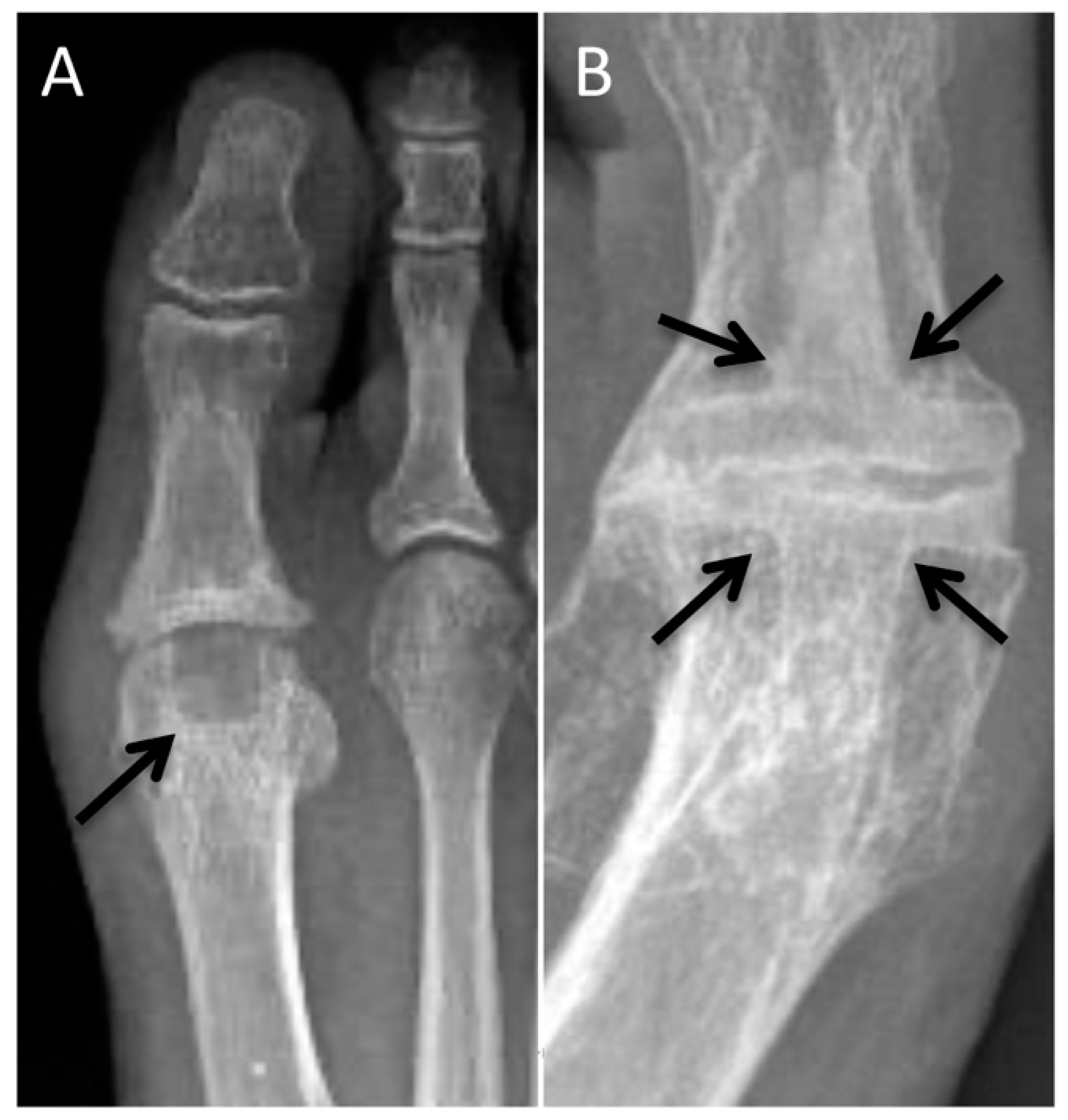 Postoperative Findings of Common Foot and Ankle Surgeries: An Imaging ...