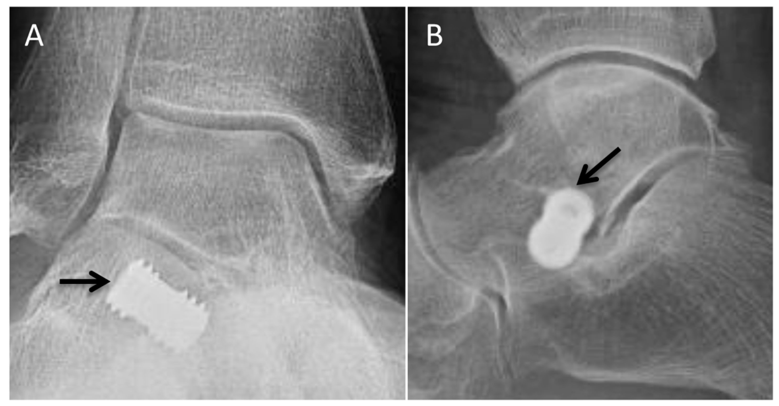 Postoperative Findings of Common Foot and Ankle Surgeries: An Imaging ...