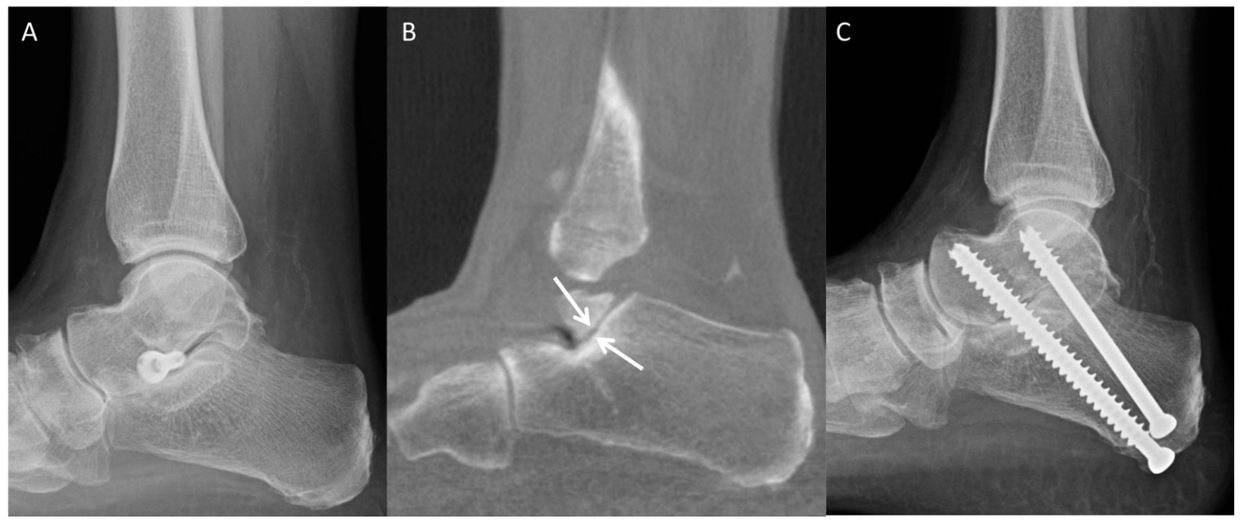 Postoperative Findings of Common Foot and Ankle Surgeries: An Imaging ...