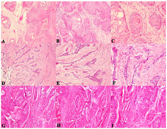 Histopathologic Feature of Hyalinization Predicts Recurrence of ...