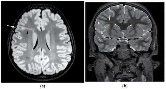 Pediatric Brain Maturation and Migration Disorders