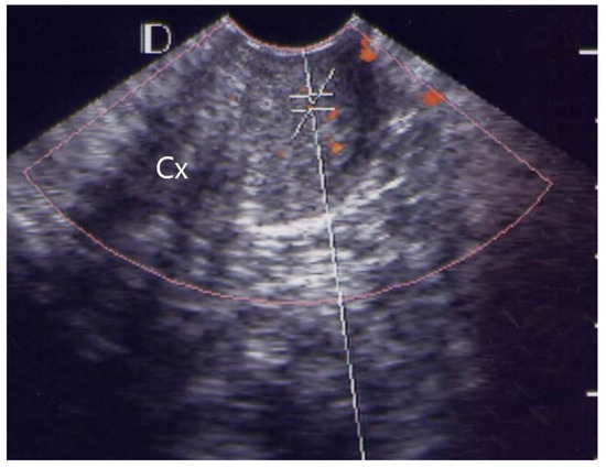 Cervical Power Doppler Angiography with Micro Vessel Blood Flow Indices ...
