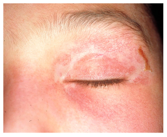 Gastrointestinal Involvement in Dermatomyositis