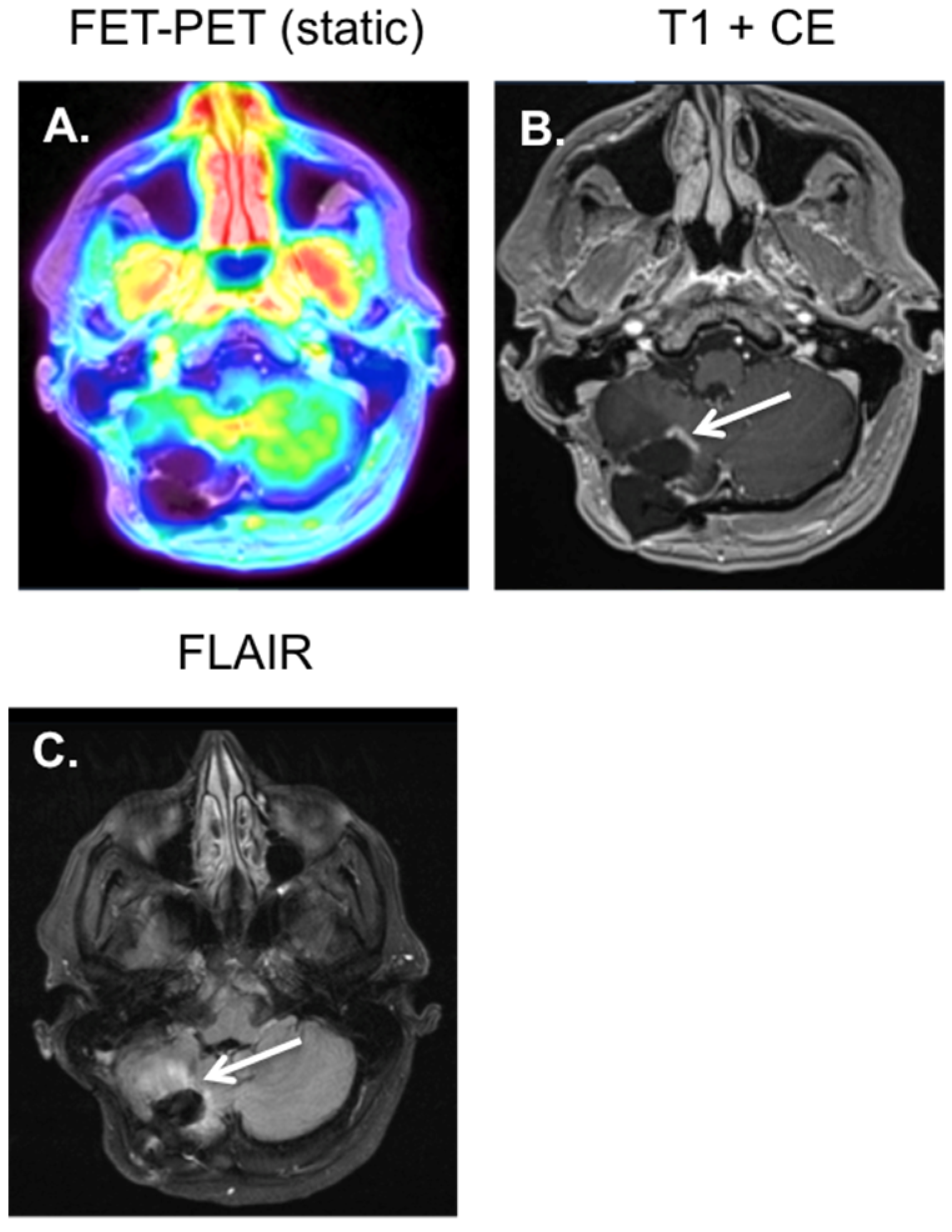 The Use of 18F-FET-PET-MRI in Neuro-Oncology: The Best of Both Worlds—A Narrative Review