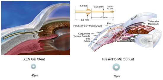 Diagnostics | Free Full-Text | Anterior Segment-Optical Coherence ...