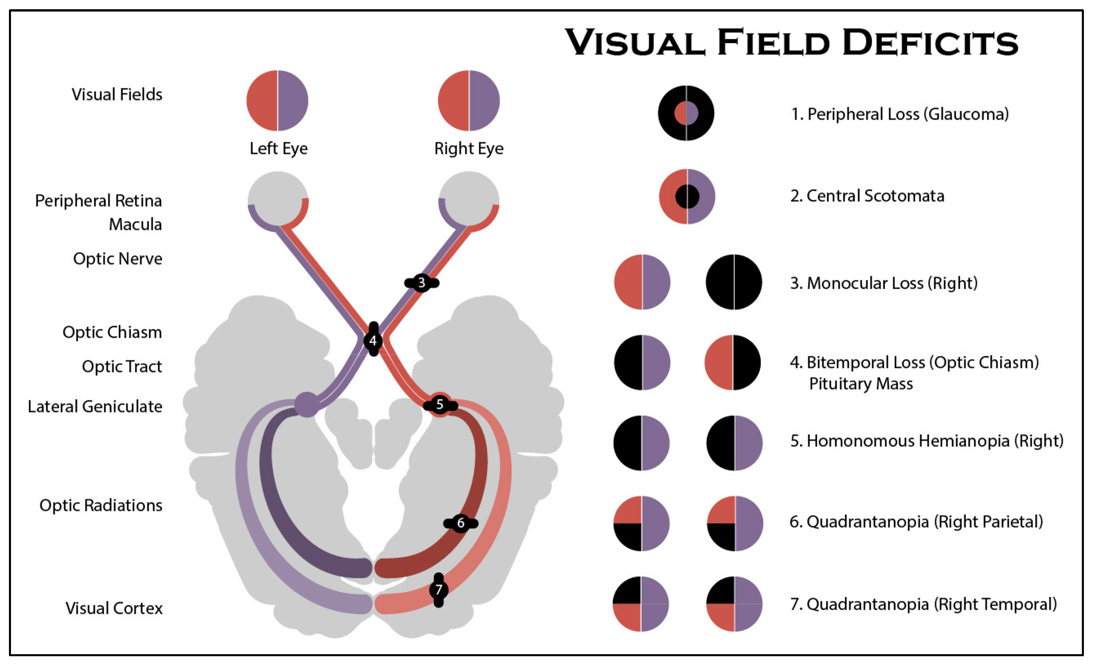 Visual Pathway And Visual Field Defects | My XXX Hot Girl Visual Pathway And Visual Field Defects | My XXX Hot Girl