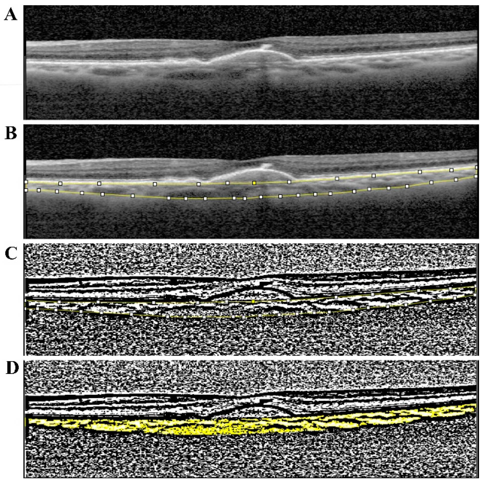Choroidal Vascular Impairment in Intermediate Age-Related Macular ...