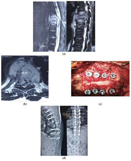 Surgical Management of Spinal Tuberculosis—The Past, Present, and Future