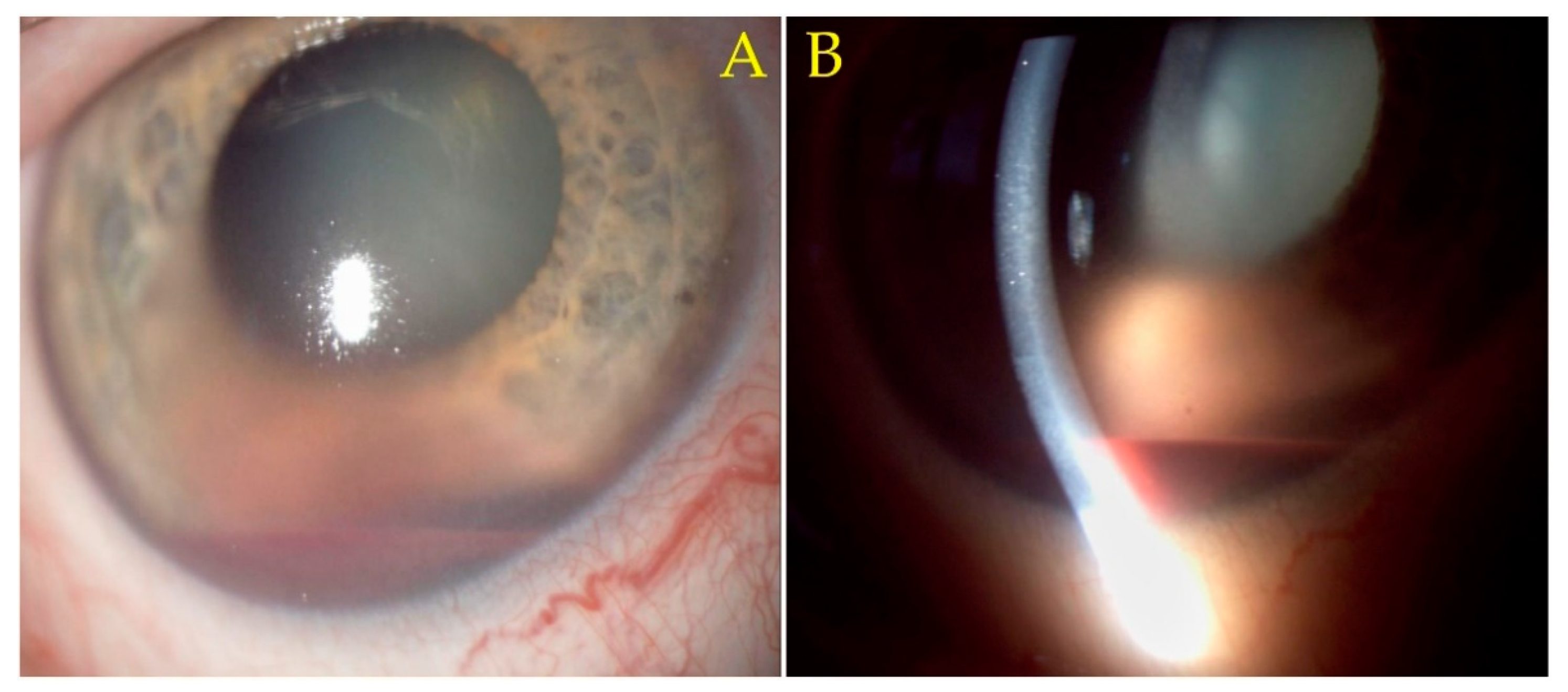 Underlying Ciliary Body Uveal Melanoma in a Patient with Chronic ...