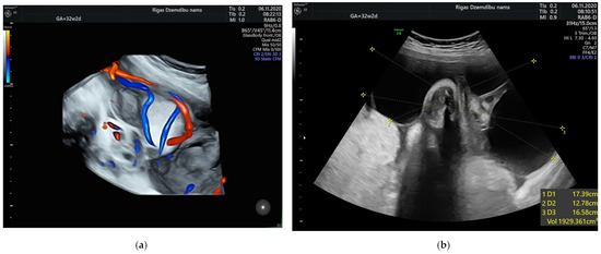 Large Angiomyxoma of the Umbilical Cord-Uncomplicated Rupture of Tumor ...