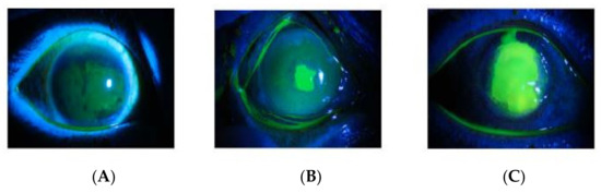 Intelligent Diagnosis and Classification of Keratitis