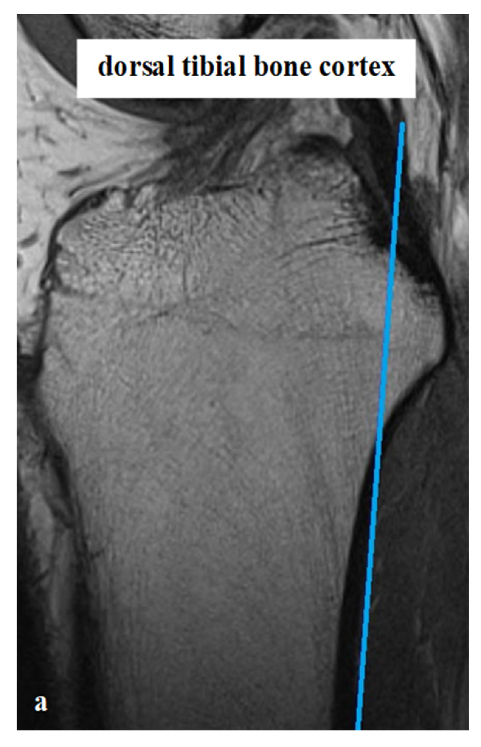 Morphological Analysis of the Tibial Slope in 720 Adult Knee Joints