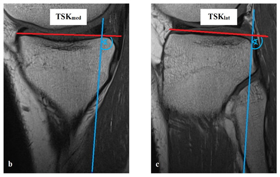 Morphological Analysis of the Tibial Slope in 720 Adult Knee Joints