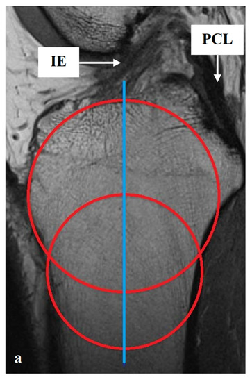 Diagnostics | Free Full-Text | Morphological Analysis of the Tibial ...