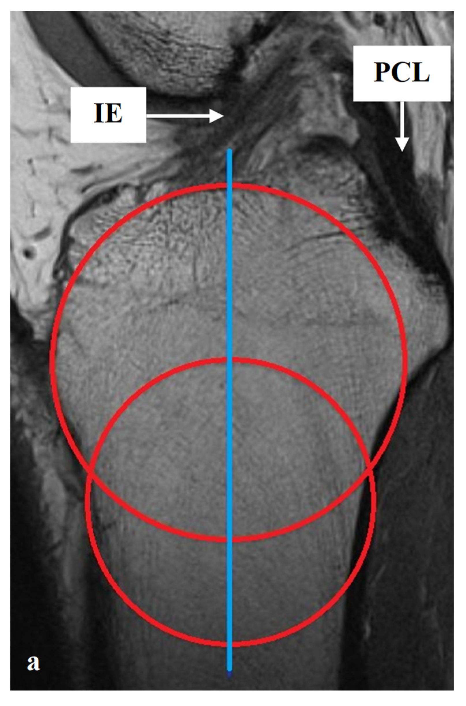 Morphological Analysis of the Tibial Slope in 720 Adult Knee Joints