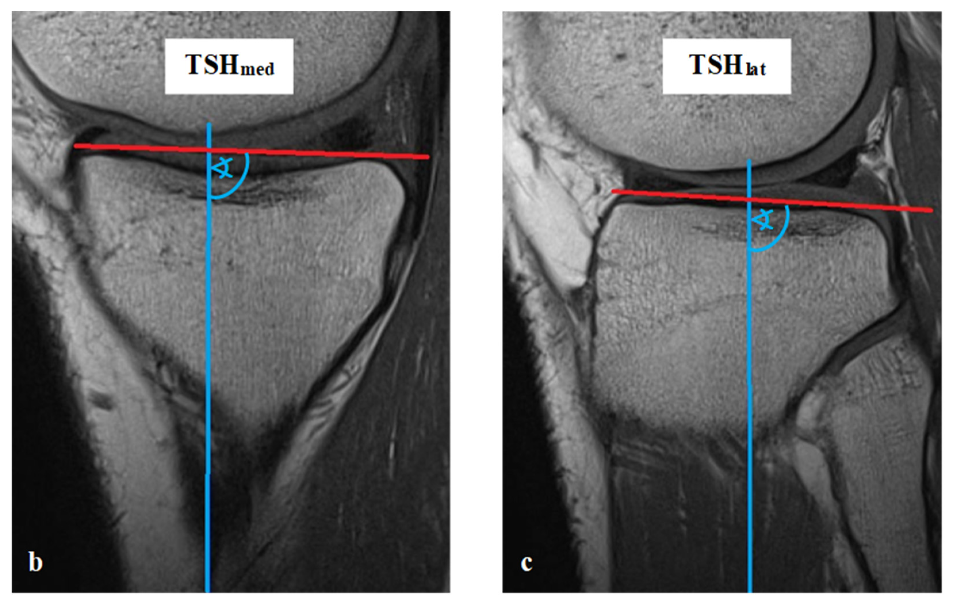 Morphological Analysis of the Tibial Slope in 720 Adult Knee Joints