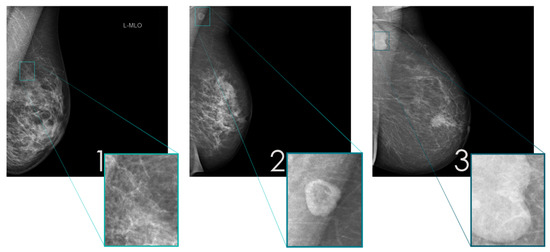 Detecting Abnormal Axillary Lymph Nodes on Mammograms Using a Deep Convolutional Neural Network