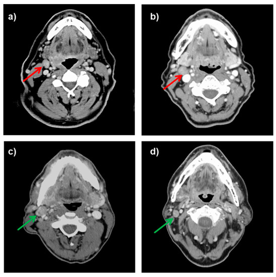 Frequency and Consequences of Cervical Lymph Node Overstaging in Head ...