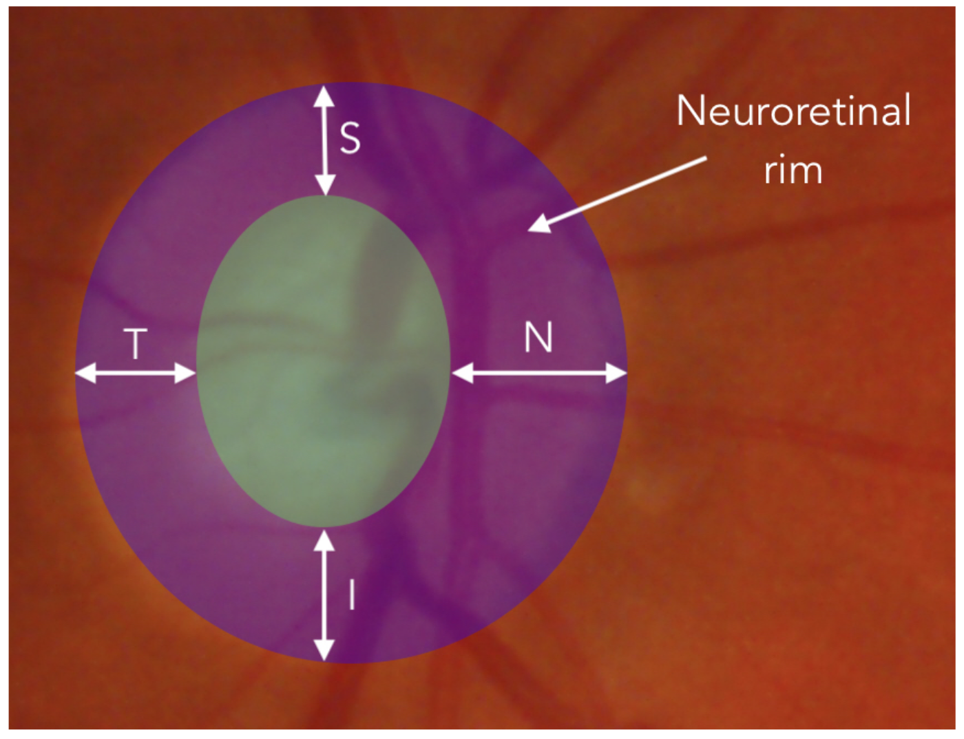 Improving Glaucoma Diagnosis Assembling Deep Networks and Voting Schemes