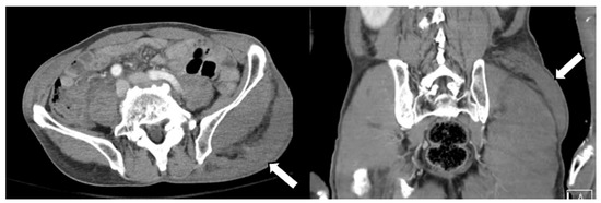 A Case Report of a Gluteus Hematoma Detected on 99mTc-MDP Bone Scan