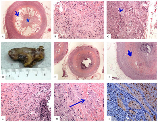 Neurogenic Appendicitis: A Reappraisal of the Clinicopathological ...