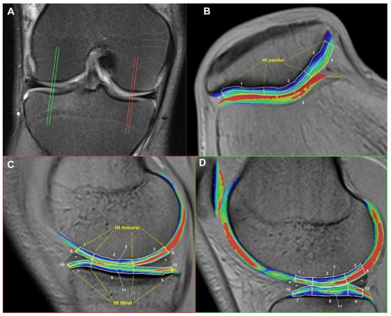 T2*-Mapping of Knee Cartilage in Response to Mechanical Loading in ...
