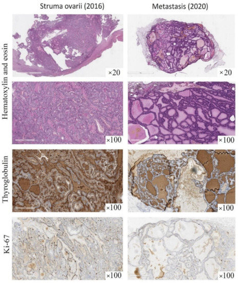 Malignant Clinical Course of “Proliferative” Ovarian Struma: Diagnostic ...