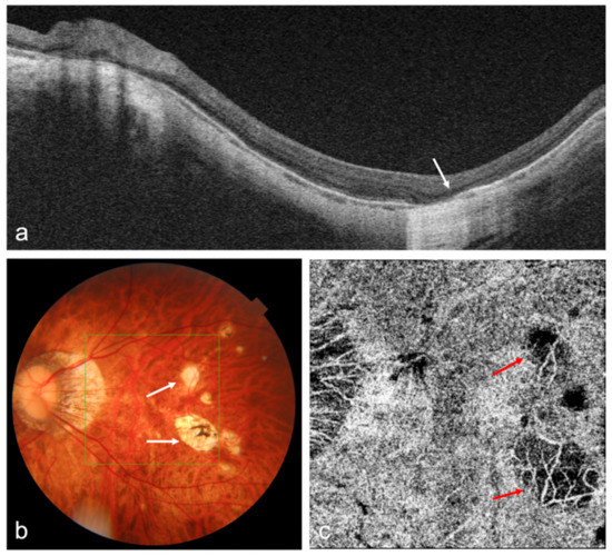 Advances in OCT Imaging in Myopia and Pathologic Myopia