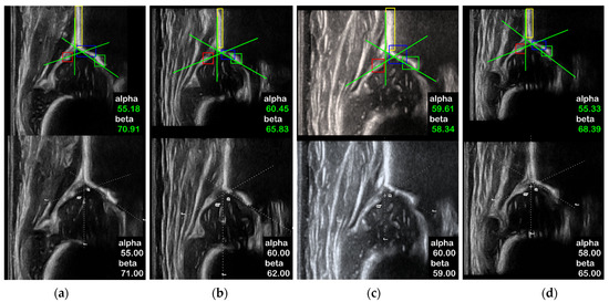 Development of a Fully Automated Graf Standard Plane and Angle ...