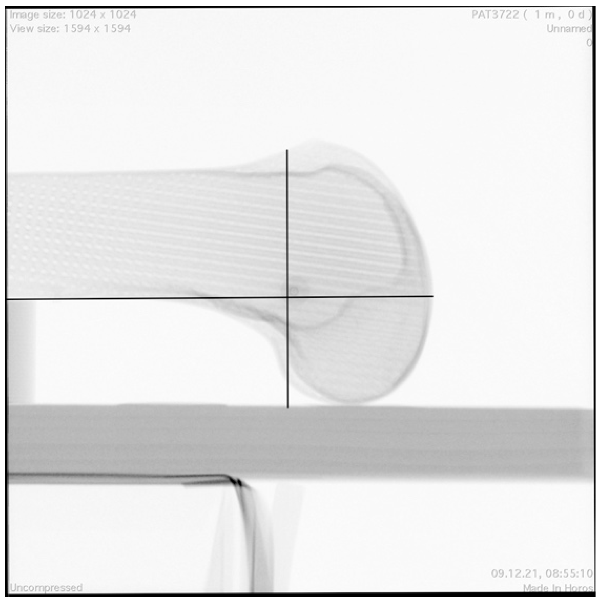 Influence of the Fluoroscopy Setting towards the Patient When ...