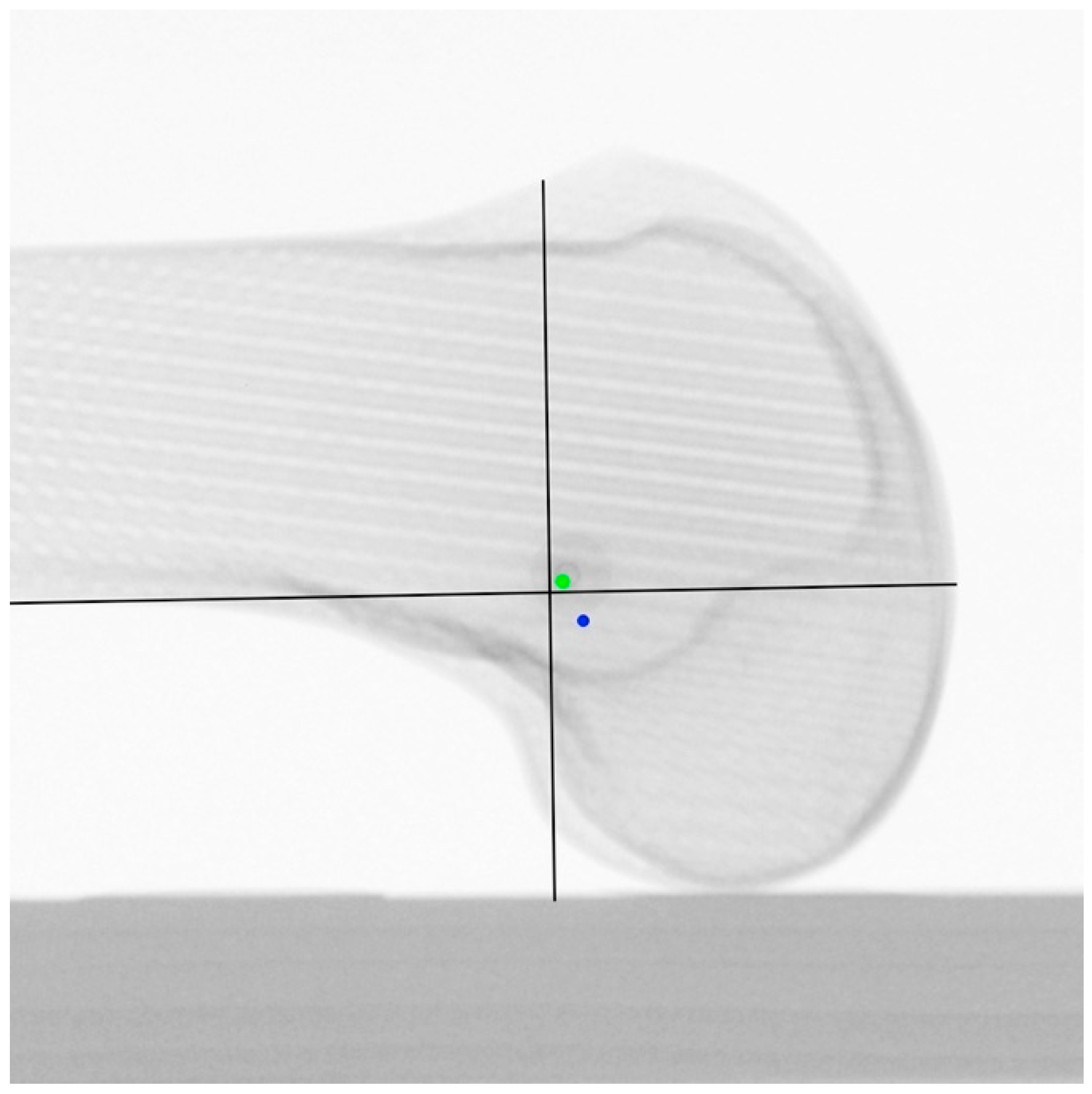 Influence of the Fluoroscopy Setting towards the Patient When ...