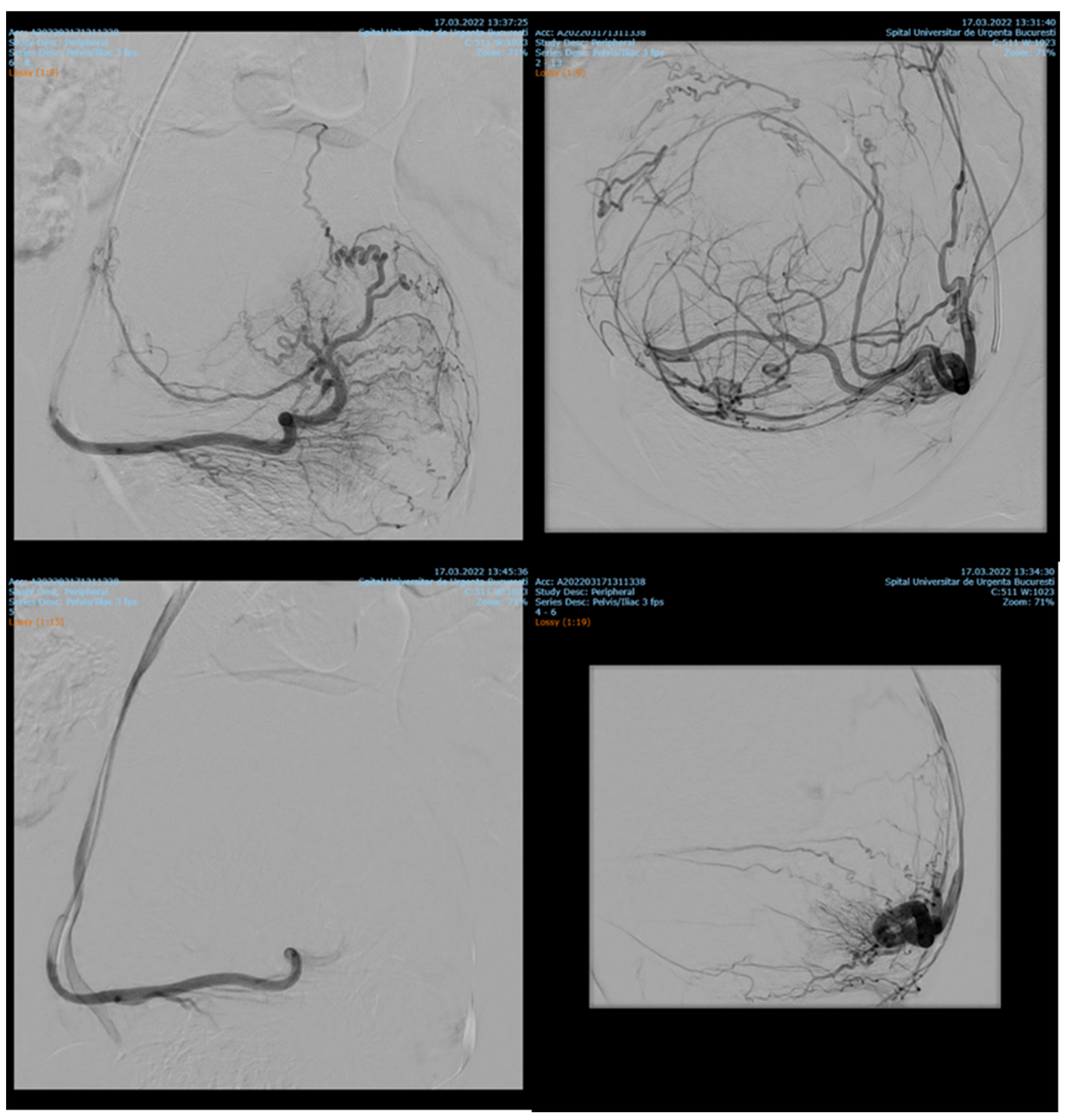 Uterine Artery Embolization For Postpartum Hemorrhage
