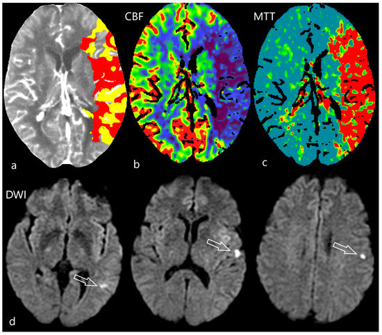 Diagnosis of Ischemic Stroke: As Simple as Possible
