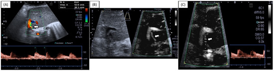 Superb Microvascular Imaging (SMI) Compared with Color Doppler ...