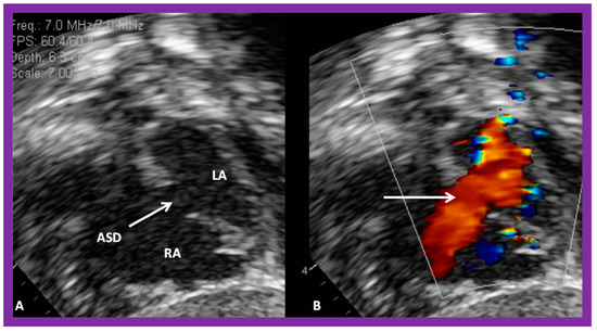 Role of Echocardiography in the Diagnosis and Interventional Management ...