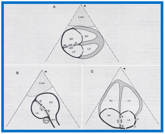 Role of Echocardiography in the Diagnosis and Interventional Management ...