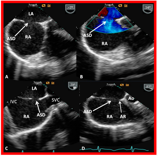 Role of Echocardiography in the Diagnosis and Interventional Management ...