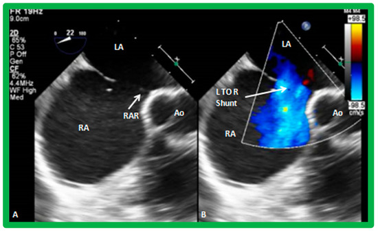 Role of Echocardiography in the Diagnosis and Interventional Management ...