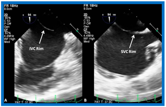 Role of Echocardiography in the Diagnosis and Interventional Management ...