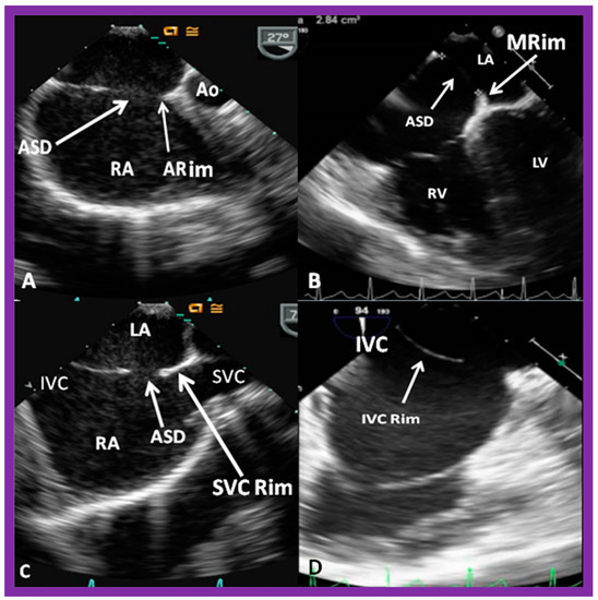 Role of Echocardiography in the Diagnosis and Interventional Management ...