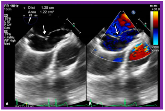 Role of Echocardiography in the Diagnosis and Interventional Management ...