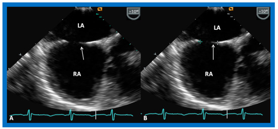 Role of Echocardiography in the Diagnosis and Interventional Management ...